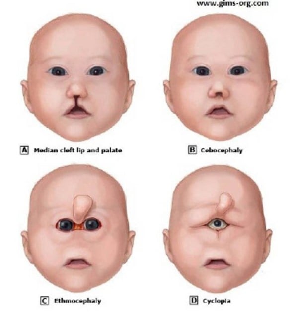 မိခင်ဗိုက်ထဲက ထွက်လာကတည်းက မျက်လုံးတစ်လုံးတည်းသာပါလာတဲ့ ကလေးလေး - Myanmarload